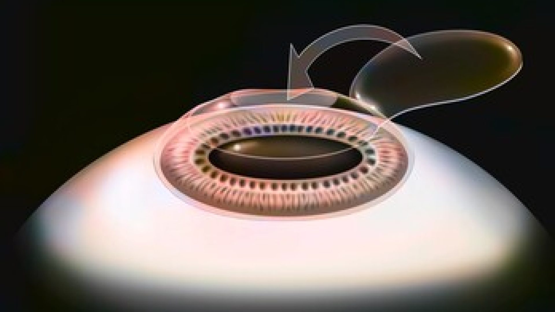 LASIK Eye Surgery: Benefits, Procedure, Risks and Recovery Guide